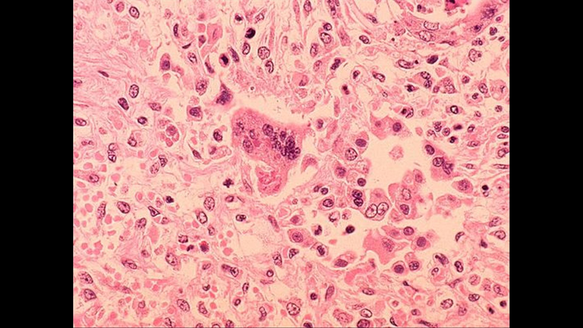 5 things about measles | wkyc.com