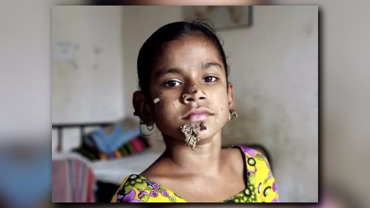 Rare 'tree man' disease may have struck first female | wkyc.com
